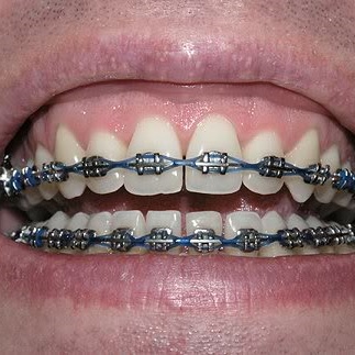 Relapse – Brock Street Dental Practice